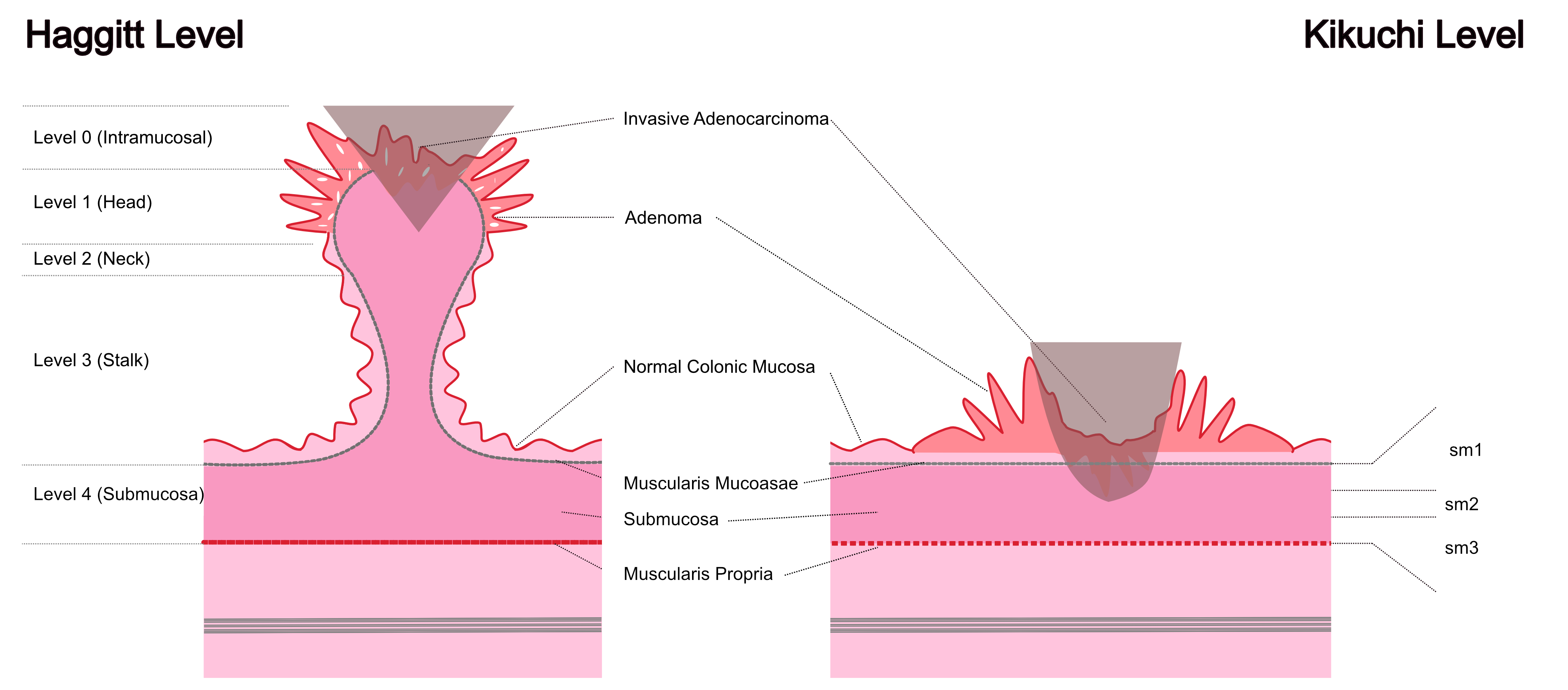 General Information – Malignant Polyp